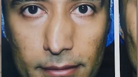 عمل ترمیمی بینی با انحراف بسیار شدید دکتر امید ابراهیمی نماشا