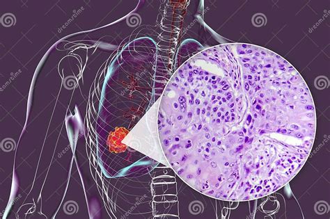 Cáncer De Pulmón 3d Ilustración Y Micrografía De Luz Stock de ilustración - Ilustración de tumor ...