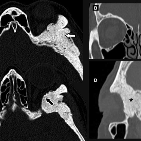 56 Yo Presenting With Left Frontal Bone Hyperostosis White Arrow