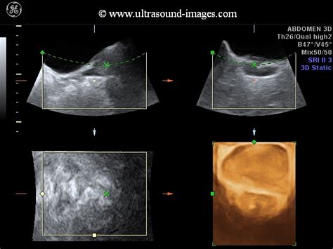 A Gallery Of High Resolution Ultrasound Color Doppler And 3d Images Prostate