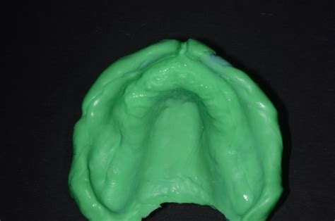8 Considerations In Denture Relining Spear Education