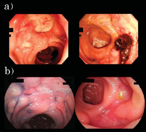 A Endoscopic Findings Of The Terminal Ileum Showed Deep And Large Download Scientific Diagram