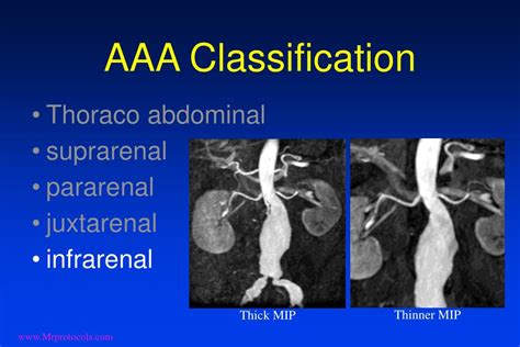 Ppt Mra Of Abdominal Aortic Aneurysms Powerpoint Presentation Free