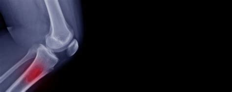 Displazie Fibroasa Cauze Simptome Diagnostic