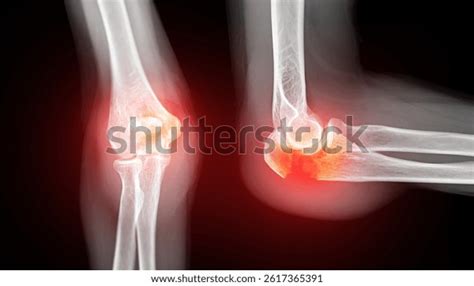 X Ray Image Showing Fracture Olecranon Process Stock Illustration