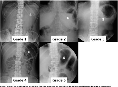 Figure 2 From Efficacy Of Gastric Balloon Dilatation And Or Retrievable Stent Insertion For