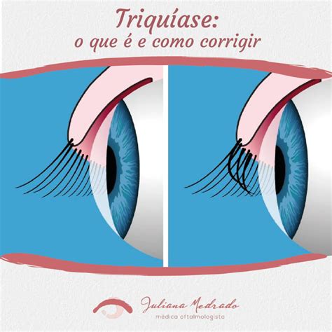 Blog Página 4 Dra Juliana Medrado Médica Oftalmologista
