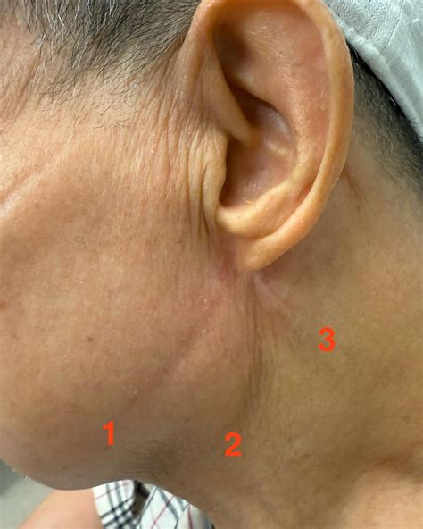 羅盛典 腮腺腫瘤 70歲男性，腮腺癌第三期 經歷手術及放射線治療 目前追蹤已近10年無恙 重點是 這樣的術後傷口 應該會讓更多的病患勇於