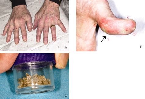 Subcutaneous Nodules Rheumatoid Arthritis