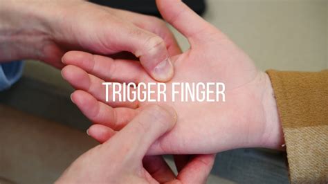 Trigger Finger Symptoms Causes And Treatment YouTube