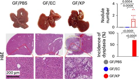 《自然》子刊：终于实锤了！中国科学家证实，肠道菌群失衡促肝癌，肺炎克雷伯菌是肝癌的致癌菌 腾讯新闻