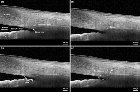 Measurements Of The Trabecular Meshwork Tm Width Tm Thickness And
