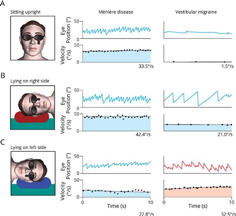 Figure 2 From Capturing Acute Vertigo Semantic Scholar