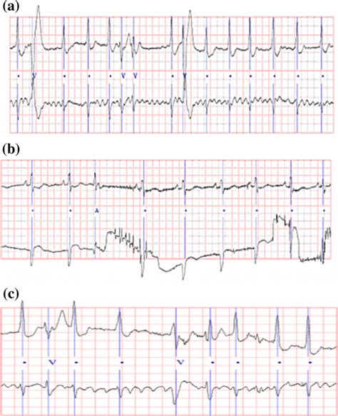 Parts Of Electrocardiographic Records Of The Analyzed Signals Included Download Scientific
