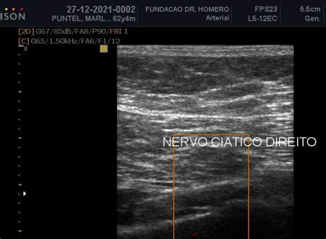Right Sciatic Nerve Hypoechoic Tubular Structure Seen Without Doppler Download Scientific