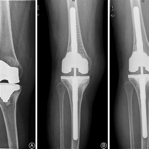A 64 Year Old Woman With Onestage Revision Of The Right Knee For