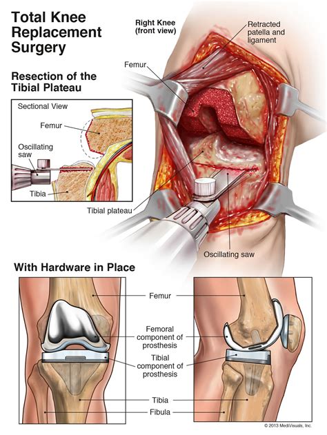 Total Knee Replacement Things You Need To Know Before Your 59 Off