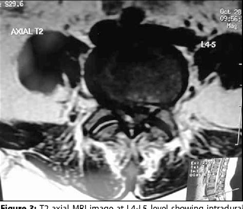 Figure 1 From Intradural Disc Herniation A Case Report Semantic
