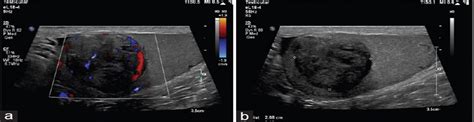Testicular Fibroma A Case Report And Literature Review Urology Annals