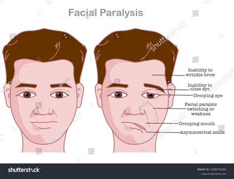 Facial Paralysis Bell Palsy Drooping Eyes Stock Vector Royalty Free
