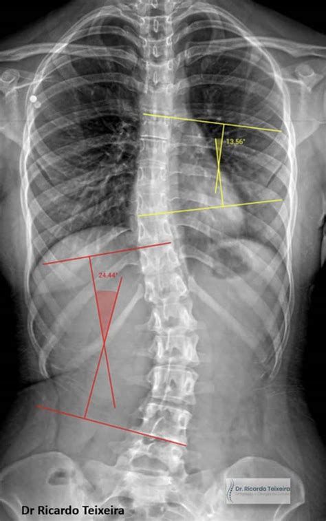 Ângulo de Cobb Diagnóstico para os casos de Escoliose