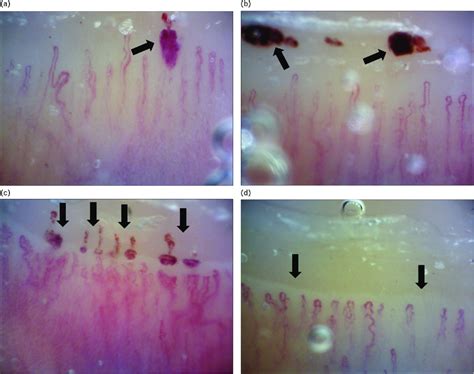 Nailfold Capillaroscopy Abnormalities Found In Patient With Acute Download Scientific Diagram