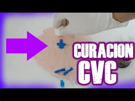 CURACIÓN DE CATETER VENOSO CENTRAL MUY FACIL YouTube