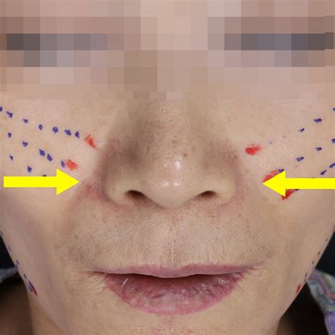 깊은 주름 패인 주름 개선을 위한 미세주름필러 의사가 직접 알려드립니다 팔자주름 네이버 블로그