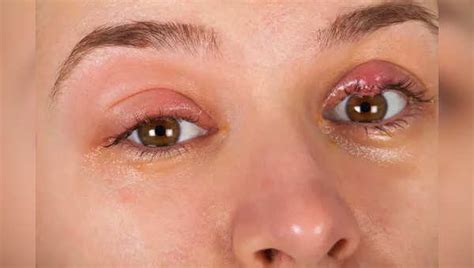 Ever Noticed A Small Lump On Your Eyelid Know All About Chalazion And