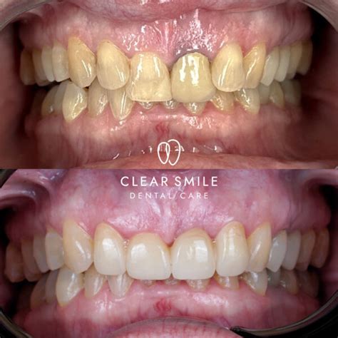 Smile Gallery Dentist Highlands Ranch Co Clear Smile Dental Care