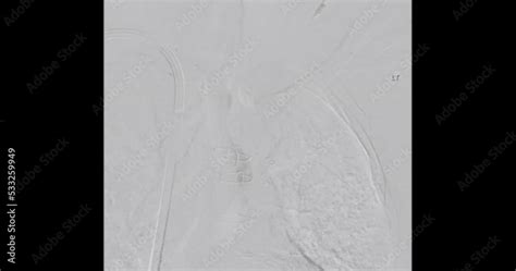 Angiogram Balloon Dialysis Catheter Inflated At Arteriovenous Av