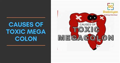 Causes Of Toxic Megacolon Visual Mnemonics Radiogyan