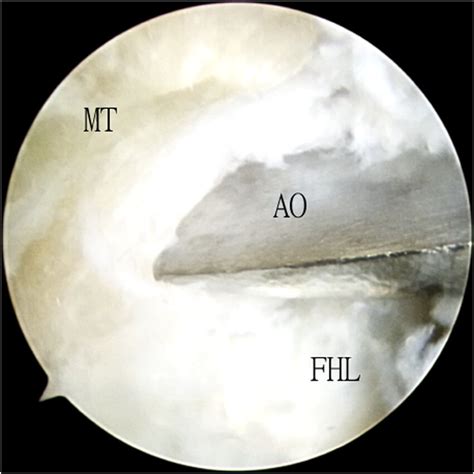 Arthroscopic Sesamoidectomy And Plantar Metatarsal Head Bone Shaving In Download Scientific