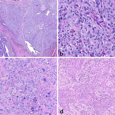 This High Grade Differentiated Thyroid Carcinoma High Grade Papillary