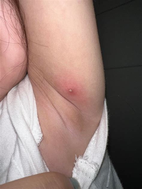 4f Is This A Harmless Pimple Mrsa Or A Bug Bite Rmedical