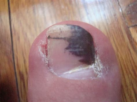 Black Fingernail Fungus Is Rare Nail Treatment Center