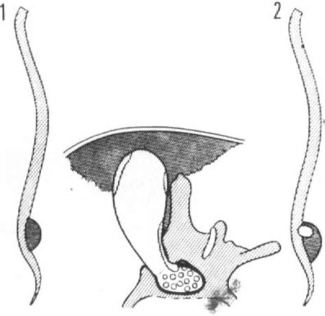 Three Cases Of Spinal Lipomas Localisation And Correlation With