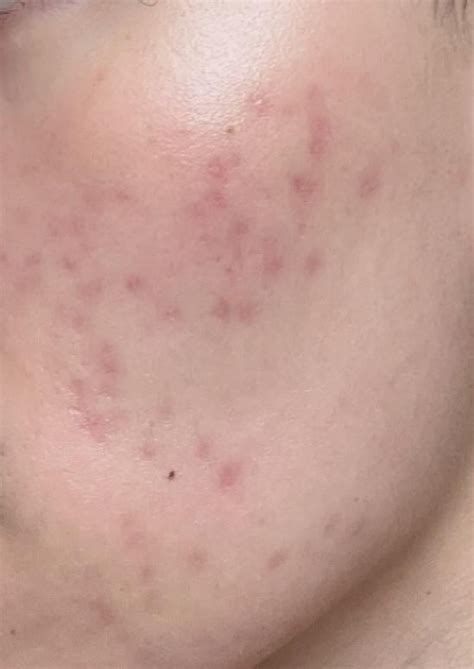 Is This Acne Pitted Scars Pie Or Pih Post Accutane Racnescars