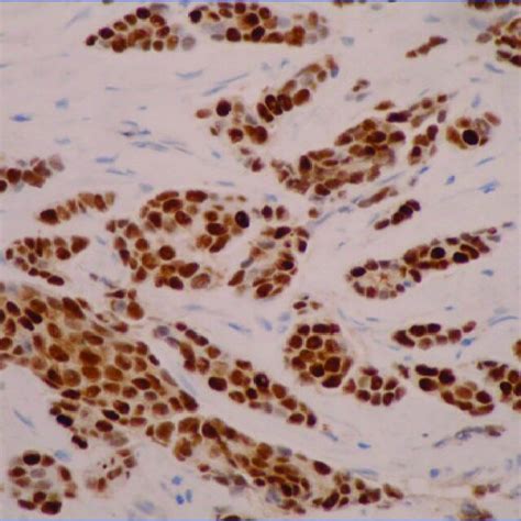 Immunohistochemical Detail Of The Primary Scalp Tumor Demonstrating