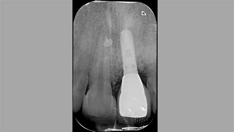 Block Augmentation With Cerabone® Jason® Membrane And Autologous Bone