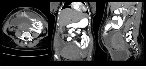 Ct Scan Showing Intra Abdominal Fluid Filled Lesion In The Lower