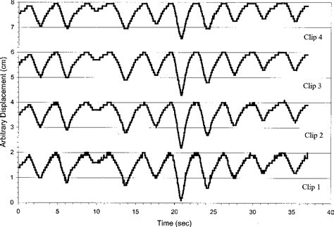 Figure 1 From Quantification Of Respiration Induced Abdominal Tumor Motion And Its Impact On