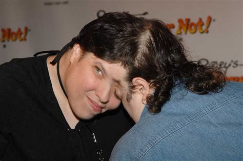 10 Most Famous Siamese Twins In The World And Their Lives Ke