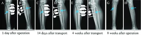 These Postoperative Radiographs Show A Tibia That Underwent Ttt A B