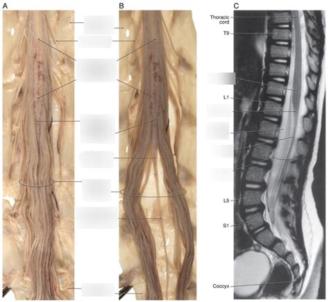 Diagram Of Conus Medullaris And Cauda Equina Quizlet