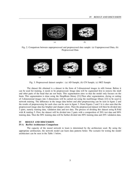 Classification Of Alzheimers Disease Using The Convolutional Neural Network Cnn With Transfer