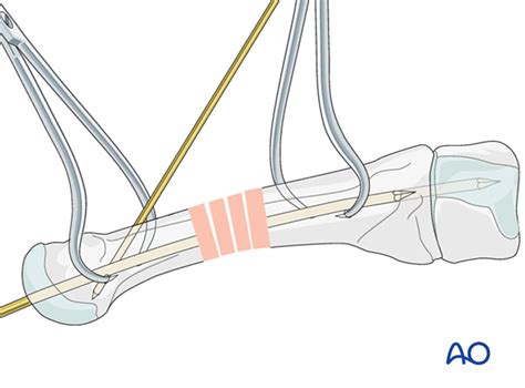 Intramedullary K Wire Fixation For Simple Diaphyseal And Proximal Extraarticular Fractures Of