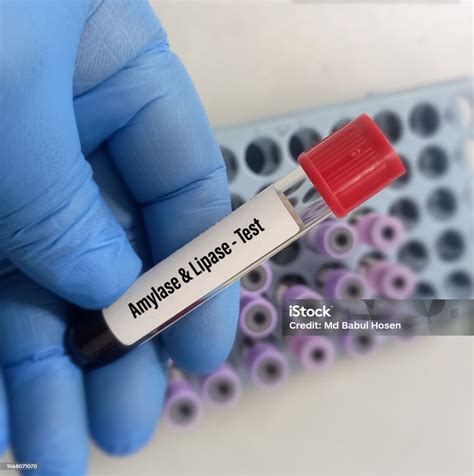 생화학자 또는 실험실 기술자는 아밀라아제 및 리파아제 효소 테스트를 위해 혈액 샘플을 보유하고 있습니다 췌장염 진단 췌장염에