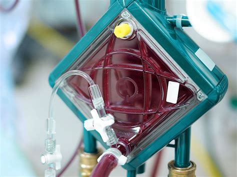 What Is A Medical Ecmo Machine At Jorge Dotson Blog