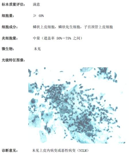 慢性宫颈炎伴CINⅠ级 局灶CINⅡ级等 数字病理远程诊断与质控平台